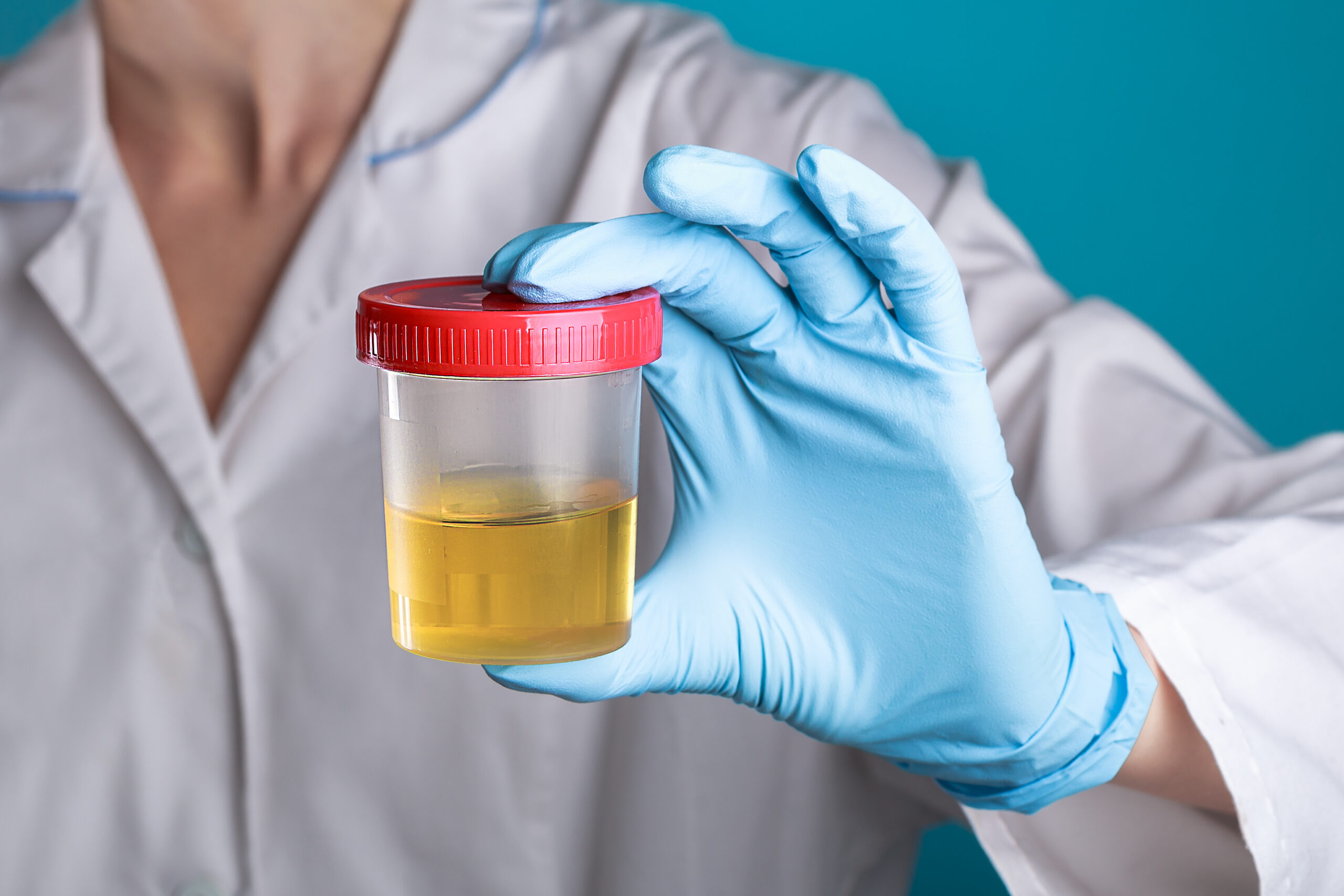 The Problem with Viewed Urine Collection—and How to Solve it with DNA ...